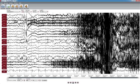Artifact Reduction Encevis