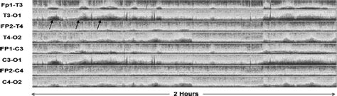 Density Spectral Array For Seizure Identification In Critica Journal Of Clinical