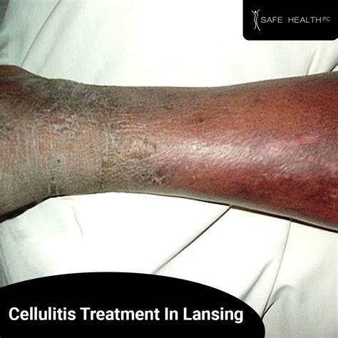 Cellulitis Skin Infection Diagnosis And Treatment