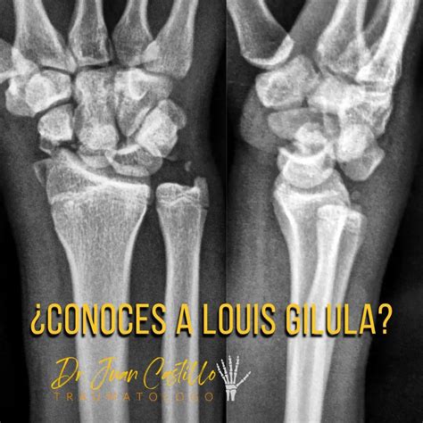 Dr ¿identificas La Lesión 🏻🫳🏻🖐🏻 Las Líneas De Gilula Nos Orientan Para Identificar O