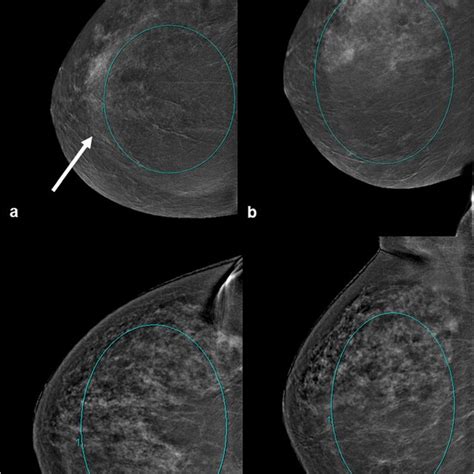 Comparison Of The Quantitative Measurement Of The Background