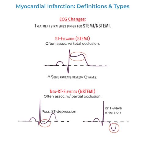 Clinical Pathology Glossary Myocardial Infarctions Types