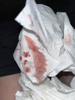 Implantation Bleeding Not Sure Babycenter