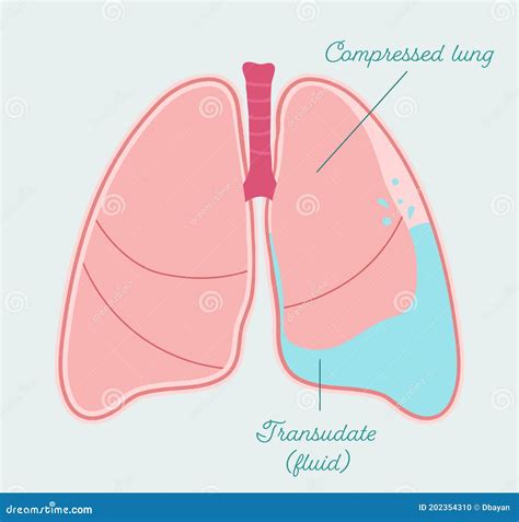 Accumulation Of Fluid In The Pleural Cavity Of The Lungs Vector Illustration