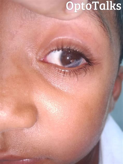 Corneal Scar Formation After Penetrating Trauma Muhammad Taimoor