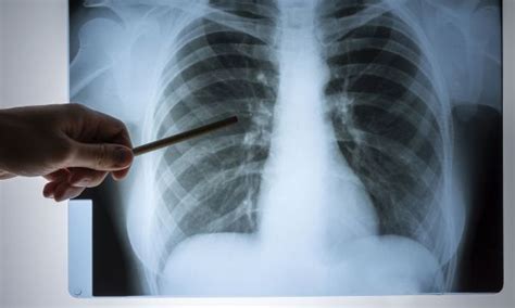 ΚΥΣΤΙΚΗ ΙΝΩΣΗ ΑΝΤΙΜΕΤΩΠΙΣΗ