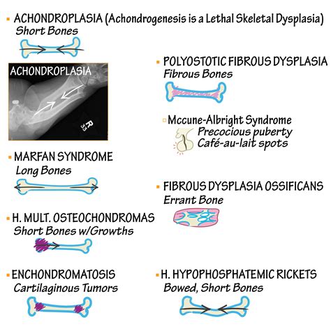 Marfan Sign In Rickets Marians Sign Is An Enlargement Of The Epiphyseal Cartilage At The