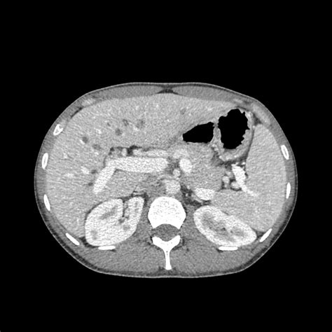 Radiopaedia Case Primary Sclerosing Cholangitis Diffuse Biliary Dilatation With Beaded
