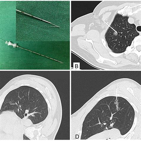 Pdf Ct Guided Hookwire Localization Before Video Assisted Thoracoscopic Surgery For Solitary