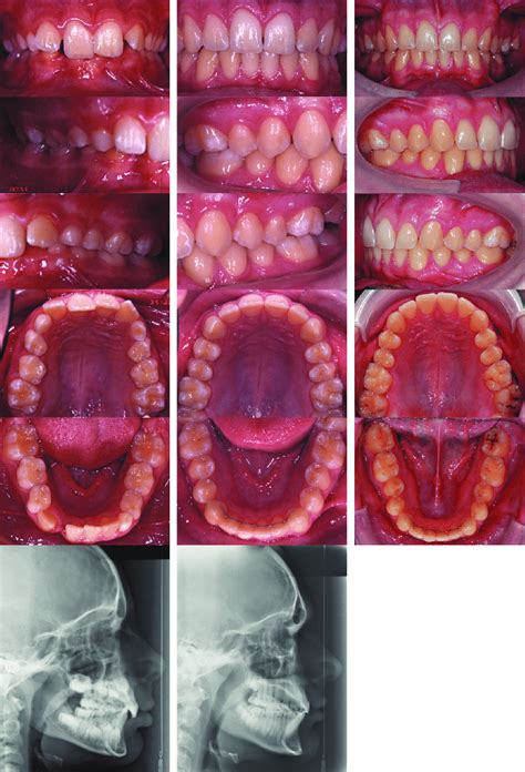 Long Term Stable Case Angle Class Ii Division 2 Skeletal Class Ii