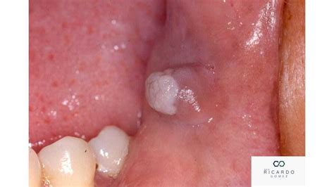 Hiperplasia Fibrosa Inflamatória Patologia Bucal