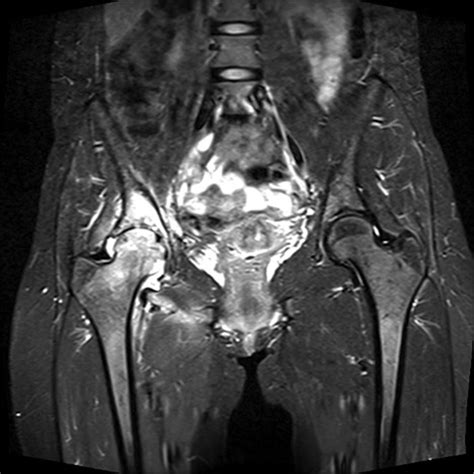 Osteoarthritis Hip Mri