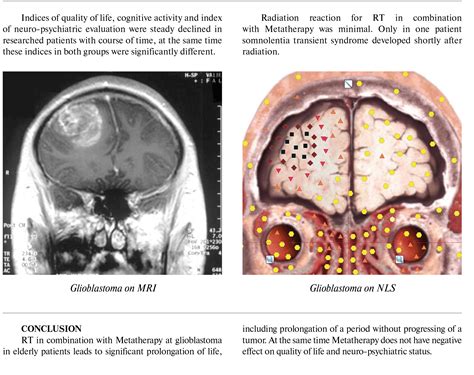 Combined Radiation Therapy And Metatherapy Of Glioblastoma In Elderly Patients