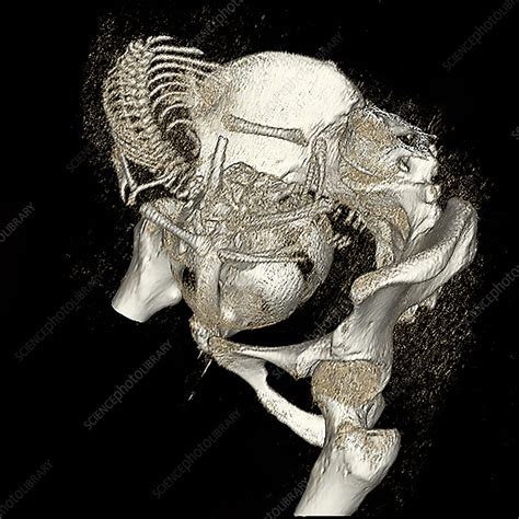 Pelvimetry Ct Scan Stock Image C035 3642 Science Photo Library