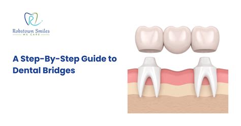A Step By Step Guide To Dental Bridges Robstown Smiles