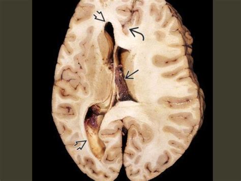 Brain Herniation Imaging