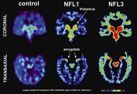The Neurocritic Is Cte Detectable In Living Nfl Players