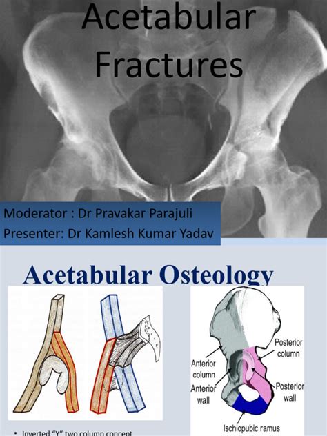 Fractures Of Acetabulum Pdf Pelvis Hip