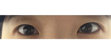 눈 재수술 자연유착 리얼후기 눈이 예쁘다 그래서 아몬드성형외과