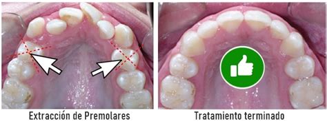Extracciones En Ortodoncia ¿cuándo Son Necesarias Solución Dental