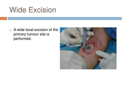 Ppt Sentinel Lymph Node Biopsy In Melanoma Powerpoint Presentation Free Download Id 847837