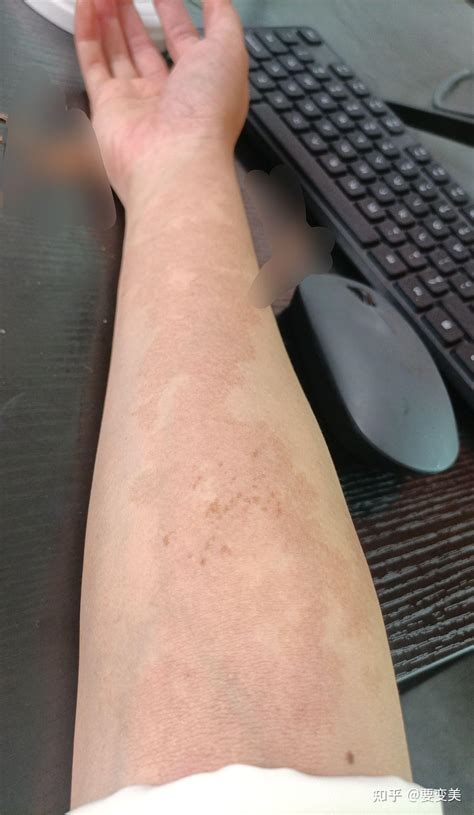 鲜红斑痣 知乎