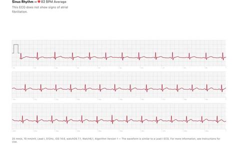 Pvcs Short Qt Interval History Of Syncope Rapplewatchecg