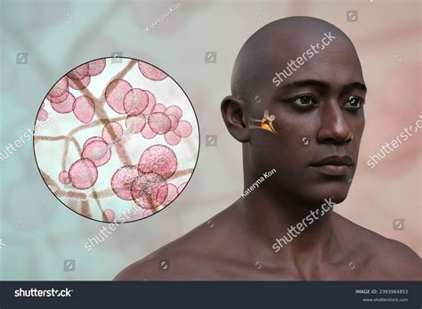 Chronic Fungal Otitis Media Ear Infection Stock Illustration 2393984853