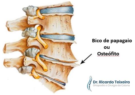 Osteófitos Da Coluna Vertebral Dr Ricardo Teixeira