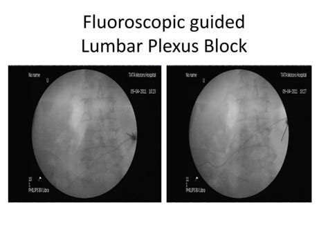 Lumbar Sacral Plexus Block Ppt