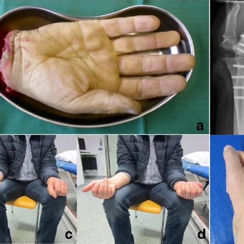 Case Two Subtotal Amputation Of The Forearm A Preoperative Picture Download Scientific