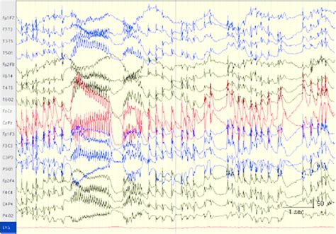 Example Eegs Showing Frequent Generalized Polyspike And Wave Complexes