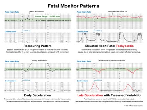 4 Fetal Monitoring Stages Of Labor Flashcards Quizlet