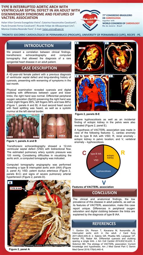 Pdf Type B Interrupted Aortic Arch With Ventricular Septal Defect In