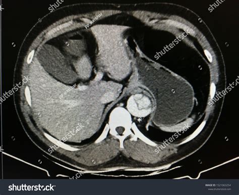 Aortic Dissection Ct Scan Stock Image M My Xxx Hot Girl