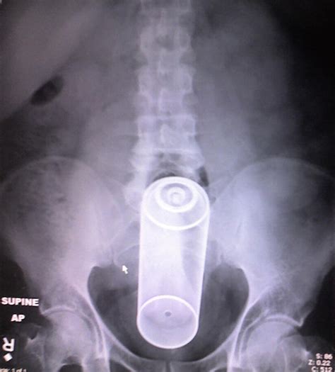 7 Tips For Diagnostic Radiology Coding Rradiologybuttstuff