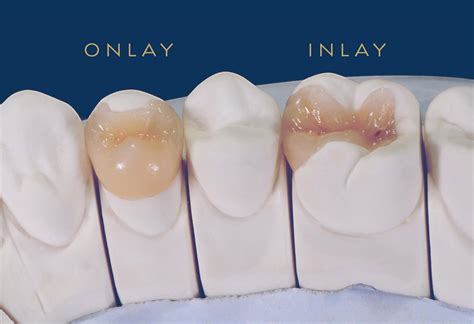 Inlayonlay Blackburn Mill Hill Dental Blackburn
