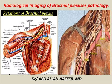 Presentation2 Radiological Imaging Of Brachial Plexus Pathology Pptx