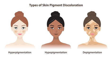 Hyperpigmentation Vector Art Icons And Graphics For Free Download