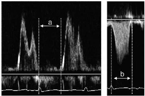 Figure 1 From Use Of Myocardial Performance Index In Pediatric Patients With Idiopathic
