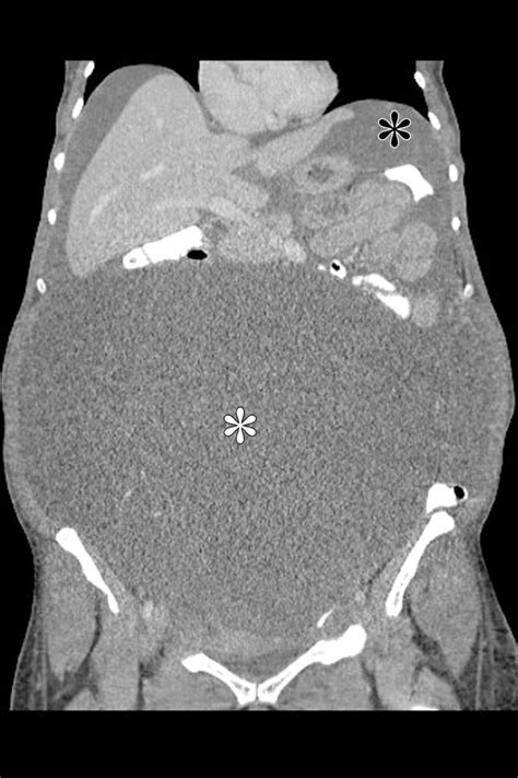 Mucinous Neoplasms Of The Ovary Radiologic Pathologic Correlation Pmc