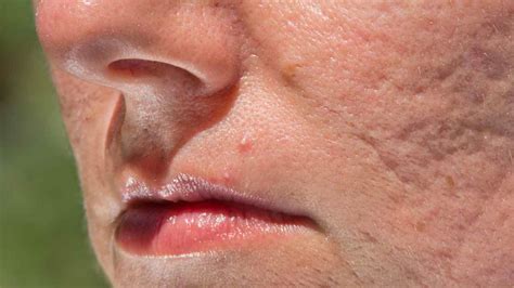 How To Know When Acne Isnt Acne Decoding Mystery Bumps