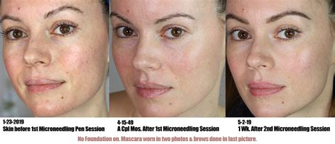 Is Swelling Normal After Microneedling Tjjvcb