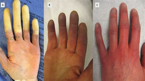 Treating Raynaud Phenomenon Beyond Staying Warm Cleveland Clinic
