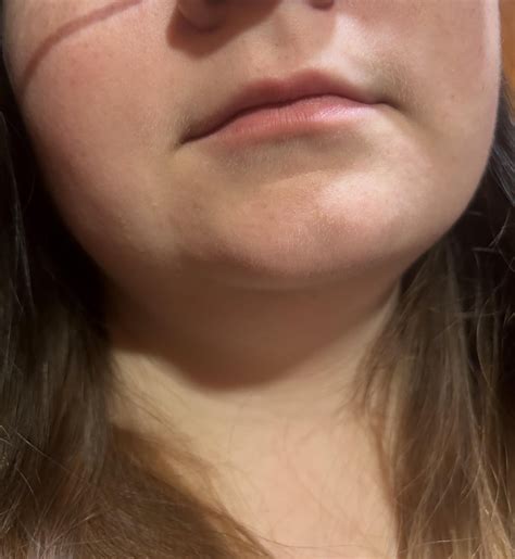 Oral Sex And Hsv1 R Coldsore