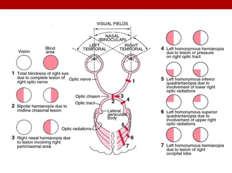 Vision Deficits Post Stroke In Service