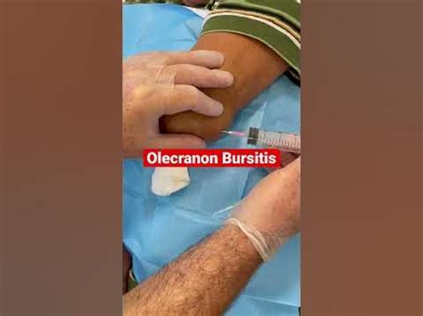 Olecranon Bursitis The Fluid Is Taken Out Just Like From A Balloon By