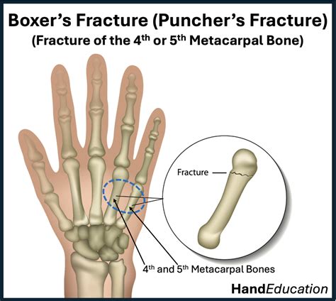 Boxers Fracture Hand Education