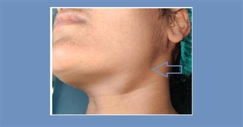 Epidermoid Cyst Of Submandibular Region An Unusual Site For Occurrence