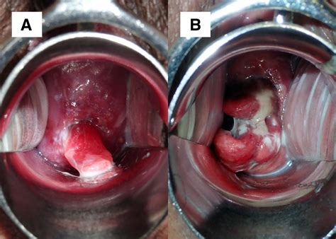 Cervical Polyps Bleeding During Pregnancy